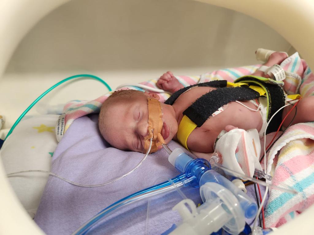 World Heart Day: Menasheh Lorincz-Griffin the smallest baby to undergo ...