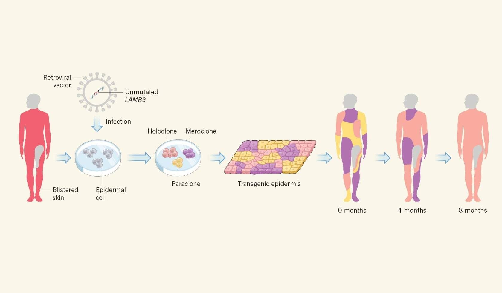 Gene therapy and grafts regrow skin of boy with incurable skin-peeling ...