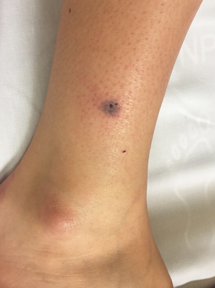 Perth woman bitten by tiger snake suffers rare delayed reaction - ABC News