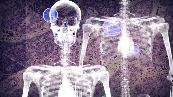 Cancer - Behind The News