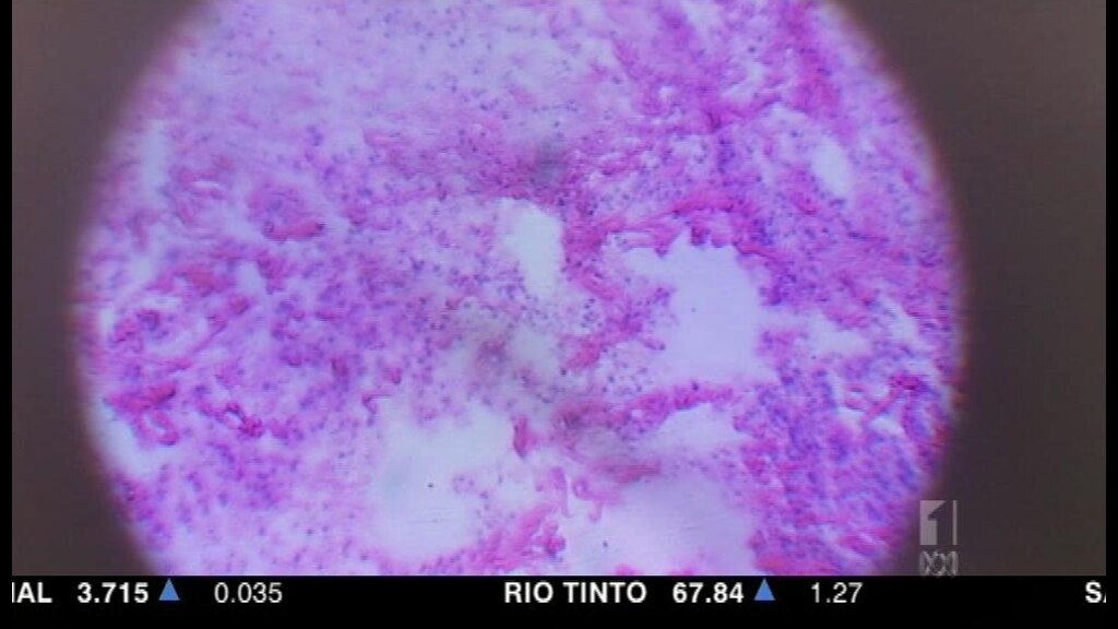 Cancer survivor fights to stop gene ownership - ABC News